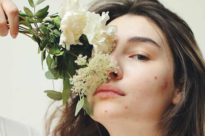 Acne triggers: What 4 doctors need you to know about breakouts and more